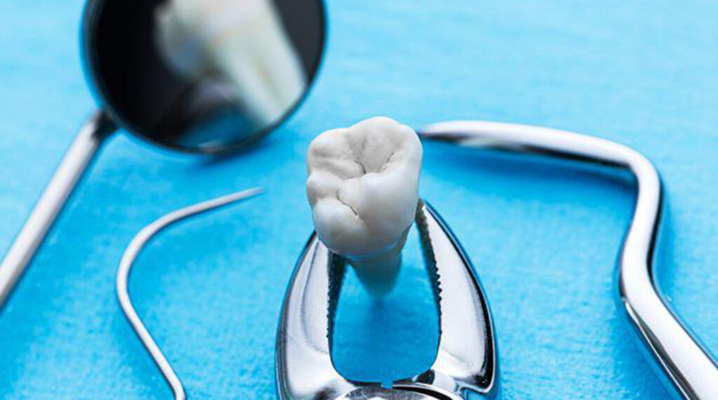 Tooth Extraction - San Fernando Pacoima Family Dentistry